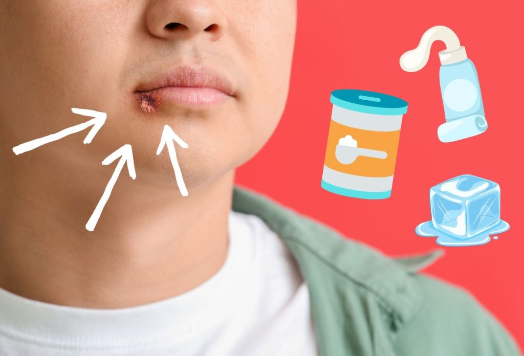 Comment soigner une engelure naturellement ? 10 remèdes de grand-mère